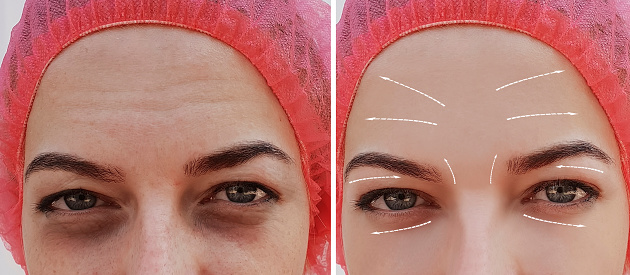 Cara Arrugas De La Cara Hermosa Chica Antes Y Después De Procedimientos ... Cara Arrugas De La Cara Hermosa Chica Antes Y Después De Procedimientos ...