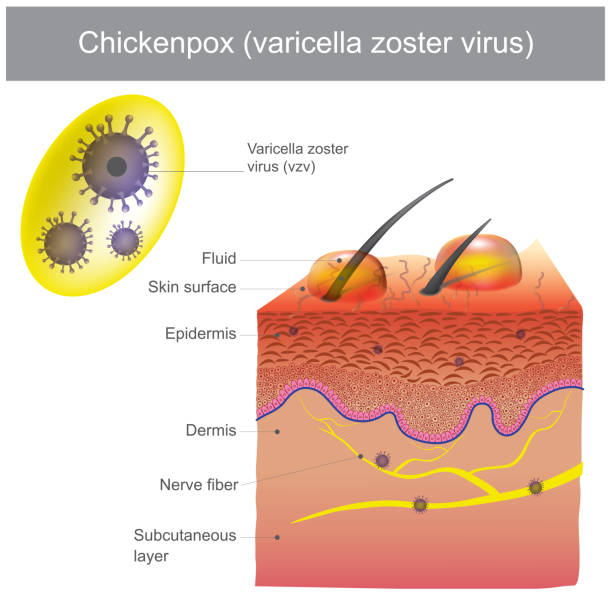 Shingles Disease Clipart