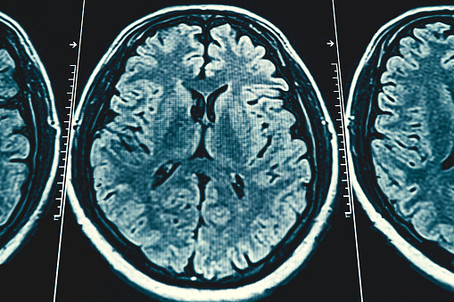 Latar Belakang Pemindaian Otak Xray Atau Mri Gambar Tomografi Resonansi ... Latar Belakang Pemindaian Otak Xray Atau Mri Gambar Tomografi Resonansi ...