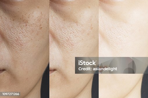 Hydroquinone Before After