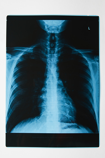 Radiografía De Un Tórax Primer Plano Película De Rayos X Del Sistema Esquelético Humano Foto De