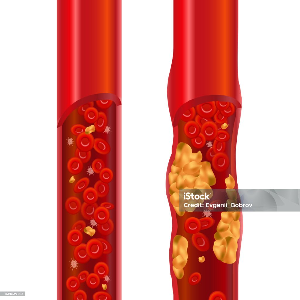 Ilustración De Arterias Sanas Y Bloqueadas Con Eritrocitos Rojos