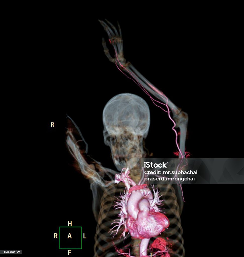 Cta Brachial Artery Or Ct Scan Of Upper Extremity Or The Arm 3d