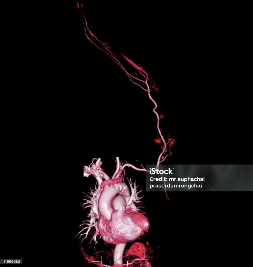 Cta Brachial Artery Or Ct Scan Of Upper Extremity Or The Arm 3d