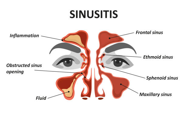 8 200 Sinusitis Ilustraciones De Stock Gráficos Vectoriales Libres De