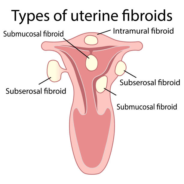 Uterus Fibroid Illustrations Royalty Free Vector Graphics And Clip Art