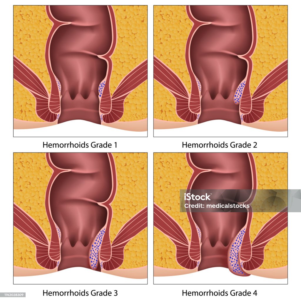 Hemorrhoids Grade Anatomy Education Info Graphic On White Background