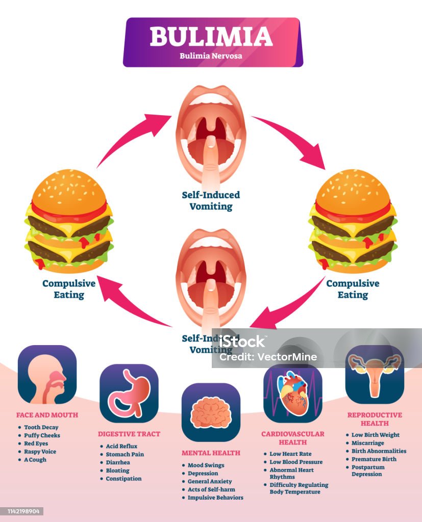 Bulimia Vector Illustration Labeled Self Induced Vomiting Diagnosis ... Bulimia Vector Illustration Labeled Self Induced Vomiting Diagnosis ...