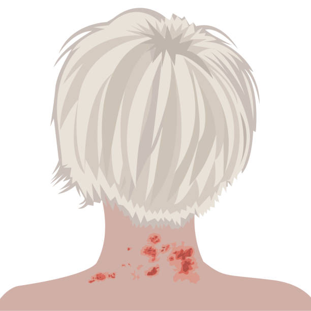 Shingles Disease Clipart