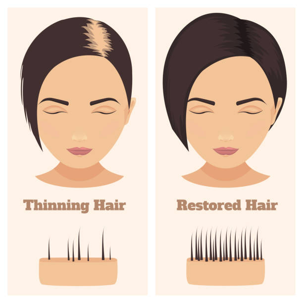 430 Female Alopecia Stock Illustrations Royalty Free Vector Graphics