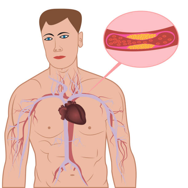 70+ Lower Cholesterol Stock Illustrations, Royalty-Free Vector Graphics ... 70+ Lower Cholesterol Stock Illustrations, Royalty-Free Vector Graphics ...