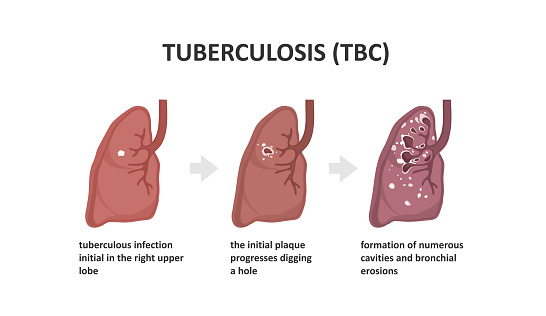 Progression Of Cavitary Pulmonary Tuberculosis Stock Illustration