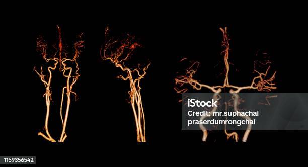 Cta Brain Atau Ct Angiography Dari Gambar Rendering 3d Otak Yang