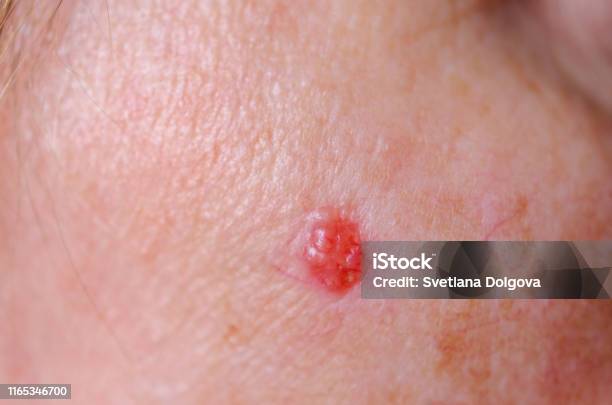 Photo libre de droit de Maladies De La Peau Problème De Lésions ... Photo libre de droit de Maladies De La Peau Problème De Lésions ...