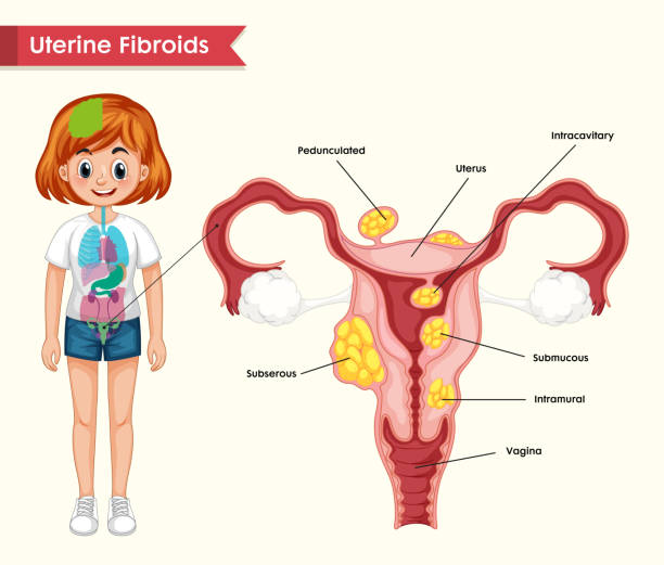 350 Uterine Fibroid Stock Illustrations Royalty Free Vector Graphics