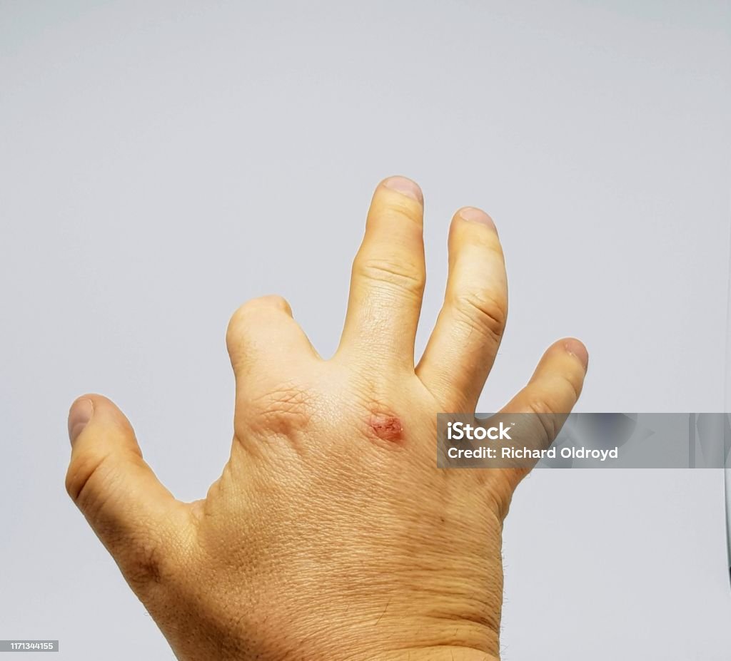 Foto De Dedo Amputado E Mais Fotos De Stock De Adulto Adulto Amputado Branco Istock