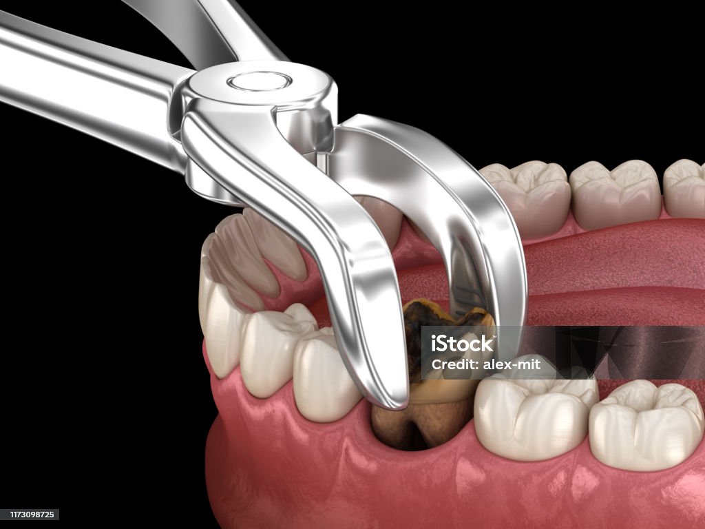 Foto De Extração De Dente Molar Danificado Por Cárie Ilustração