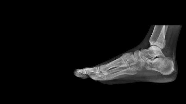 calcaneus fracture People | Built Structure | Broken | Data ...