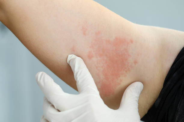 Shingles Rash On Neck