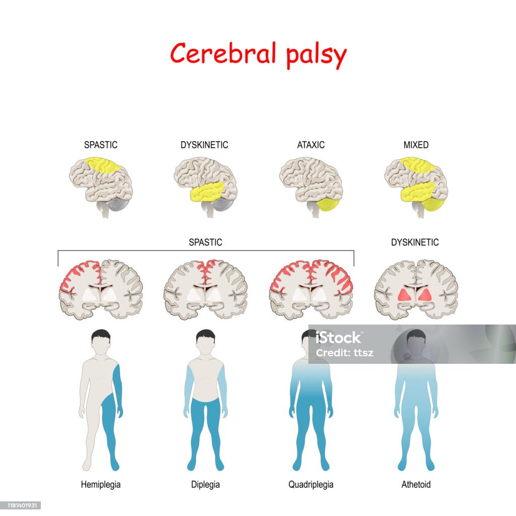 Cerebral Palsy Otak Manusia Dengan Area Mixed Ataxic Dyskinetic Dan ... Cerebral Palsy Otak Manusia Dengan Area Mixed Ataxic Dyskinetic Dan ...