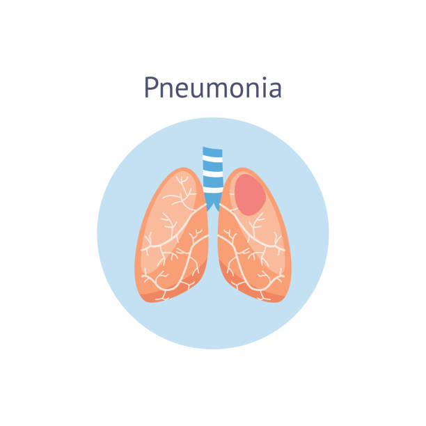 120+ Alveoli Damage Stock Illustrations, Royalty-Free Vector Graphics ... 120+ Alveoli Damage Stock Illustrations, Royalty-Free Vector Graphics ...