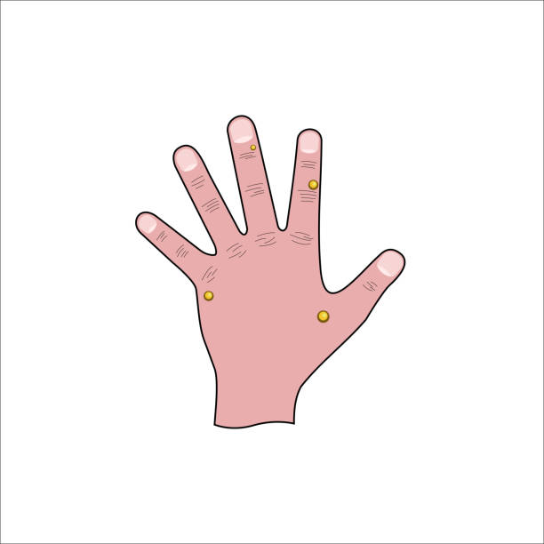 560+ Papiloma Ilustrasi, Grafik Vektor, & Clip Art Bebas Royalti ... 560+ Papiloma Ilustrasi, Grafik Vektor, & Clip Art Bebas Royalti ...