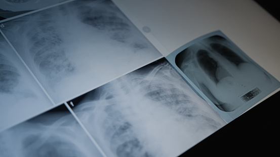 Konsep Radiografi Paruparu Dokter Radiologi Memeriksa Di Film Rontgen