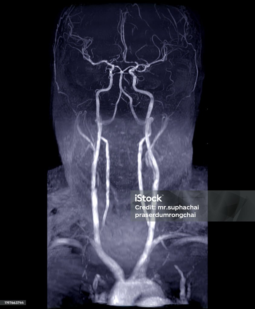 Mra Angiografía Cerebral Y De Cuello O Resonancia Magnética De La
