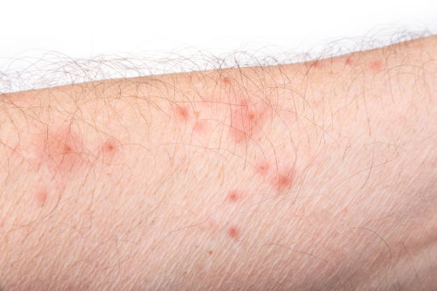 Scabies Rash On Arms