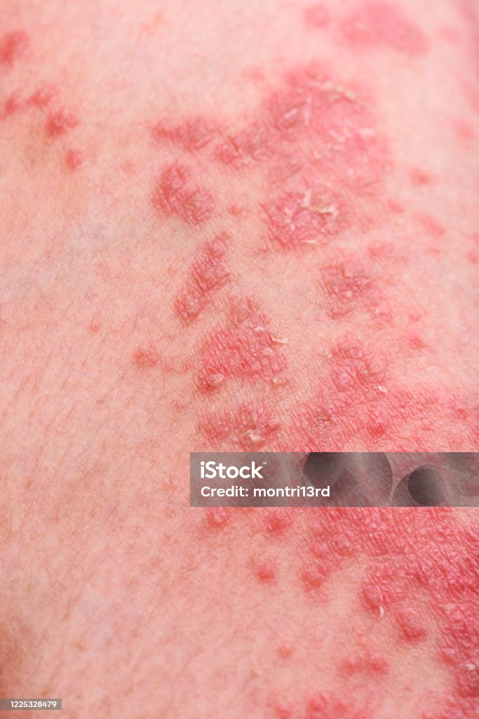 Psoriasis Skin Psoriasis Is An Autoimmune Disease That Affects The Skin