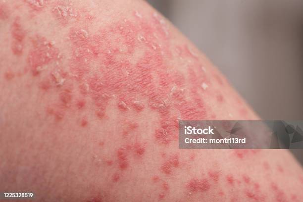 Psoriasis Skin Psoriasis Is An Autoimmune Disease That Affects The Skin