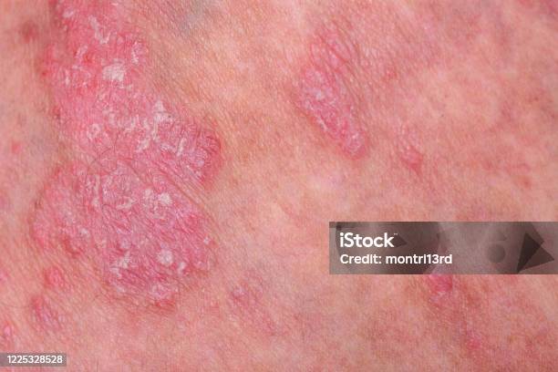 Psoriasis Skin Psoriasis Is An Autoimmune Disease That Affects The Skin