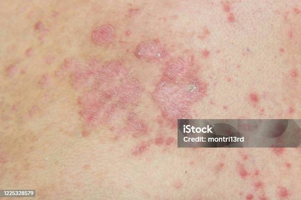 Psoriasis Skin Psoriasis Is An Autoimmune Disease That Affects The Skin