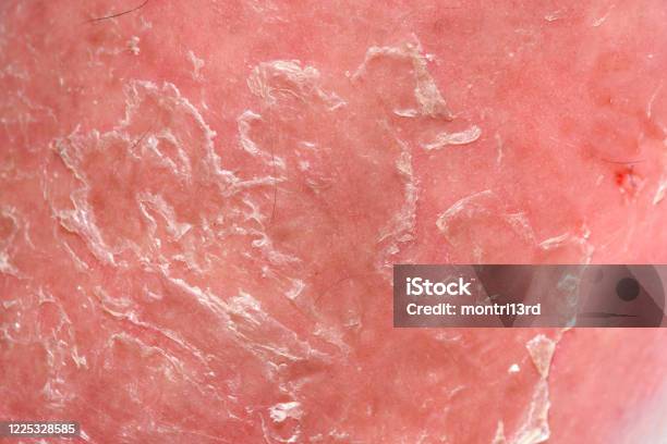 Psoriasis Skin Psoriasis Is An Autoimmune Disease That Affects The Skin