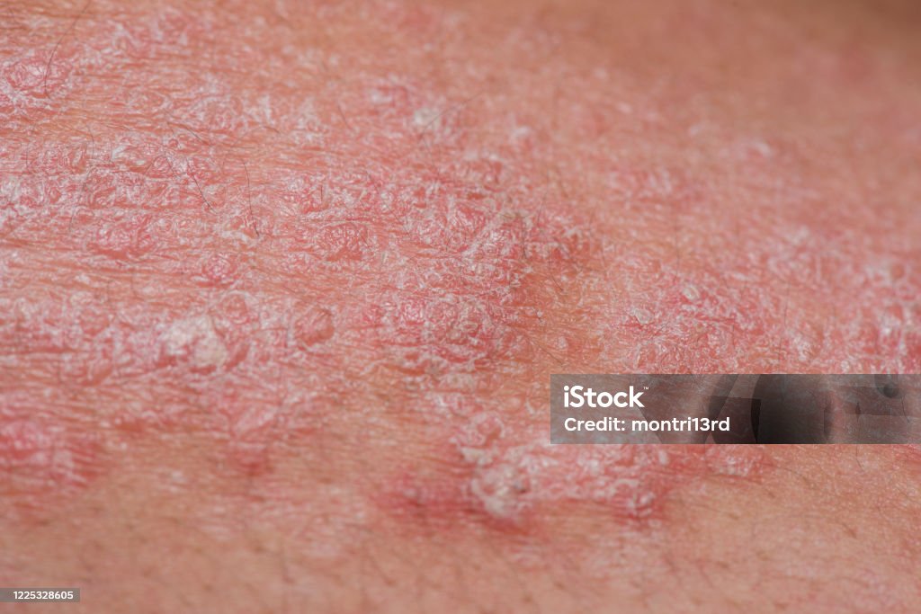 Psoriasis Skin Psoriasis Is An Autoimmune Disease That Affects The Skin