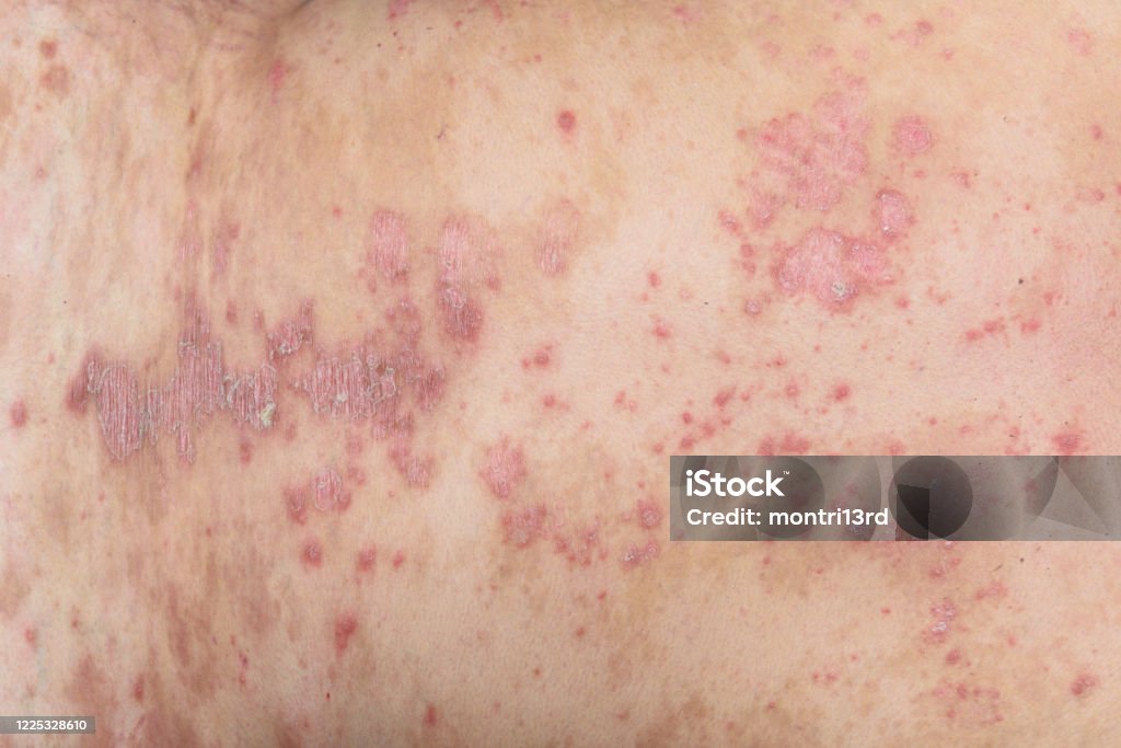 Psoriasis Skin Psoriasis Is An Autoimmune Disease That Affects The Skin