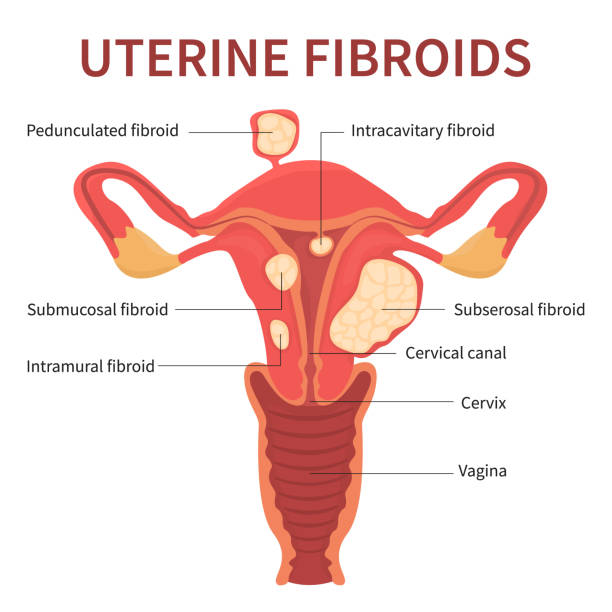 350 Uterine Fibroid Stock Illustrations Royalty Free Vector Graphics