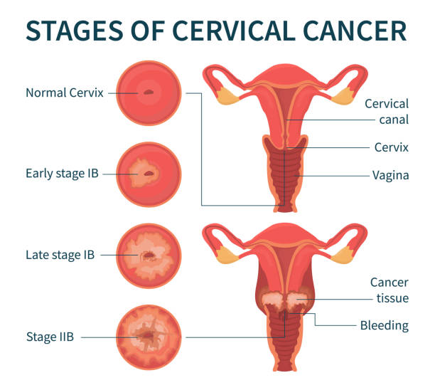 70 Cervical Dysplasia Stock Illustrations Royalty Free Vector