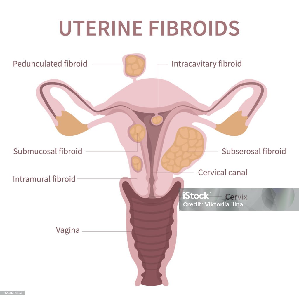 Woman Uterine Fibroids Diagram On White Background Stock Illustration