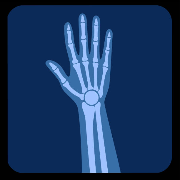 Arthrose Du Poignet Vectoriels Et Illustrations Libres De Droits Istock