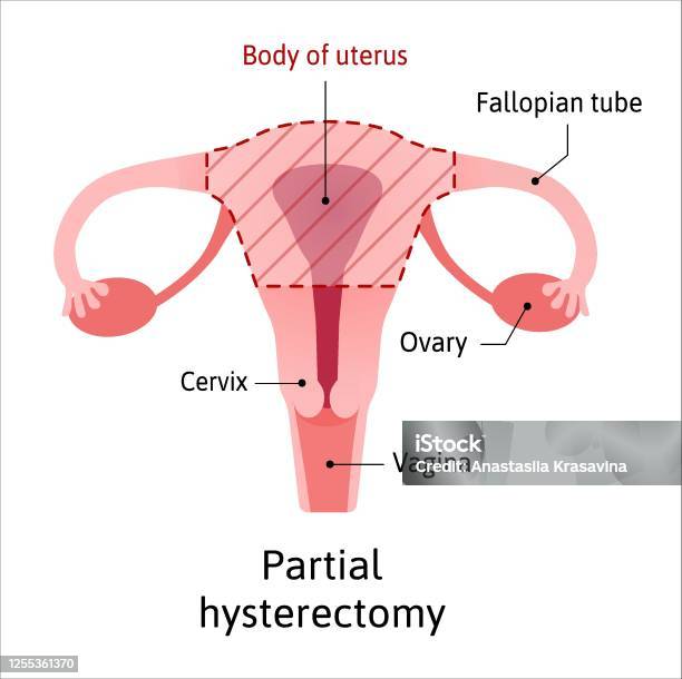 Hystérectomie Ablation Chirurgicale De Lutérus Illustration Vectorielle