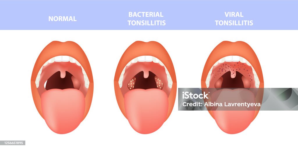 Open Mouth Normal And Tonsillitis Bacterial And Viral Angina Pharyngitis And Tonsillitis