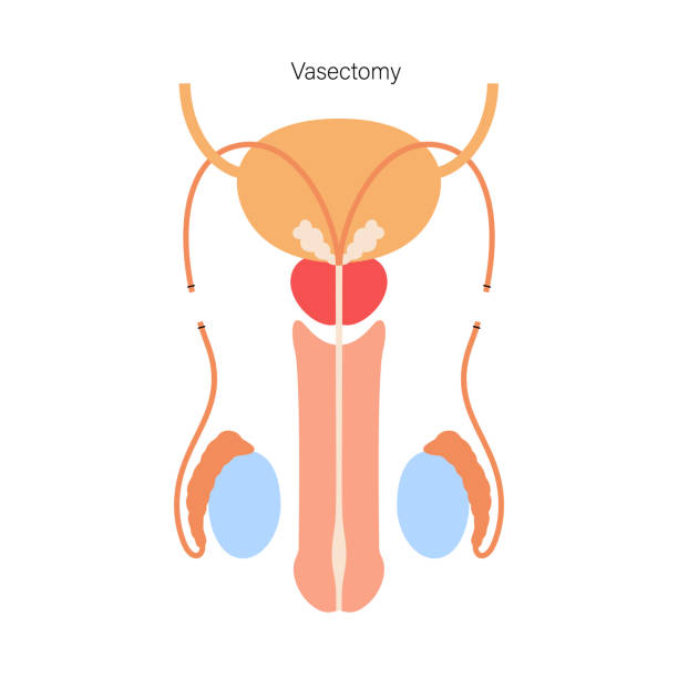 150 Vasectomy Stock Illustrations Royalty Free Vector Graphics And Clip