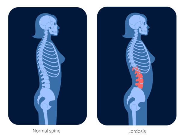30 Cervical Lordosis Stock Illustrations Royalty Free Vector Graphics