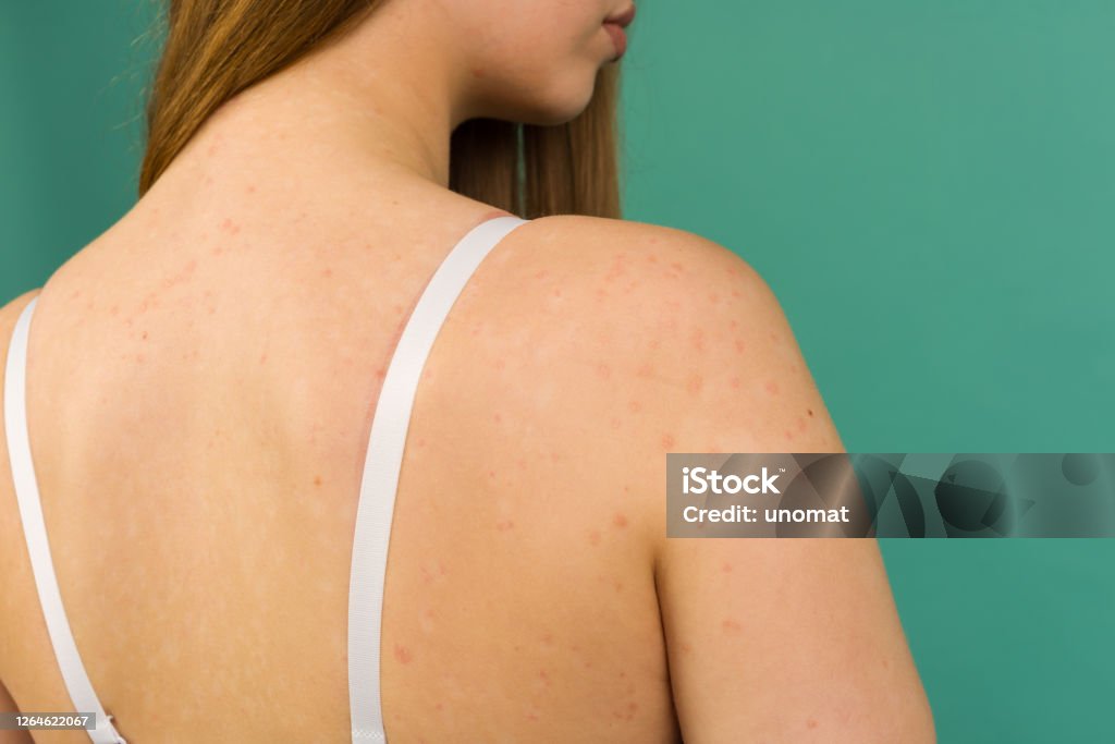 Foto De Closeup Jovem Irreconhecível Que Sofre De Doença Dermatológica