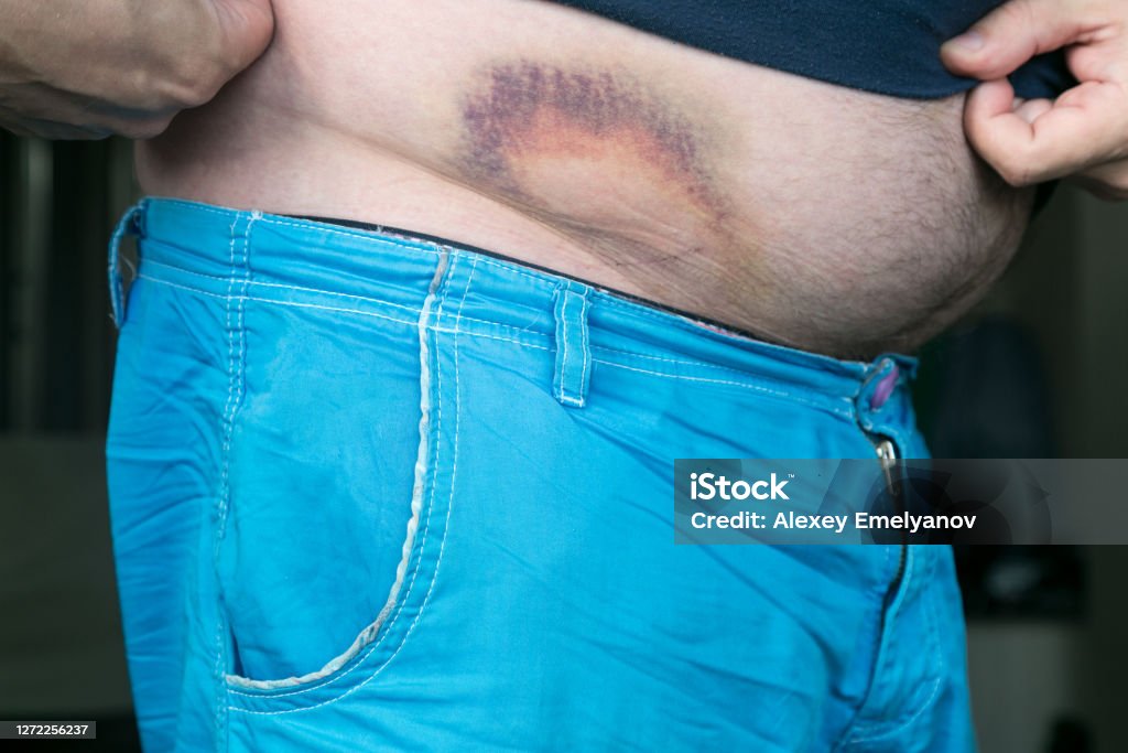 Hematoma Hematoma En El Cuerpo Humano Gran Hematoma Hematoma En El ... Hematoma Hematoma En El Cuerpo Humano Gran Hematoma Hematoma En El ...