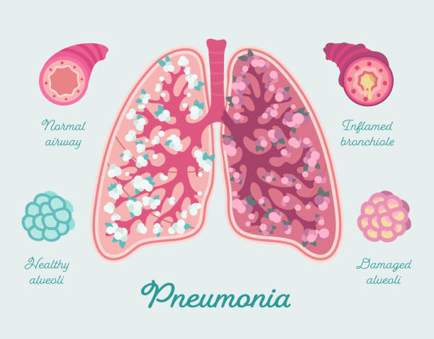 120+ Alveoli Damage Stock Illustrations, Royalty-Free Vector Graphics ... 120+ Alveoli Damage Stock Illustrations, Royalty-Free Vector Graphics ...
