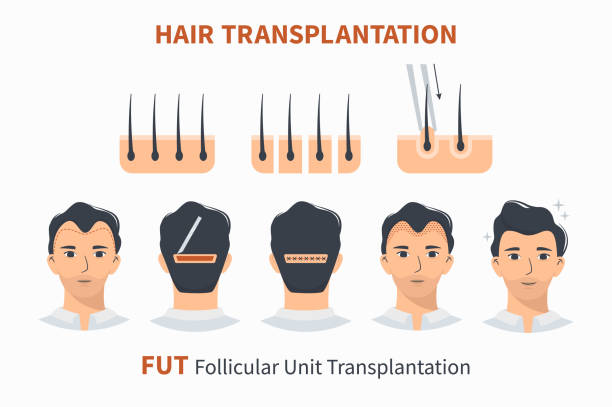 20 Follicular Unit Extraction Illustrations Royalty Free Vector