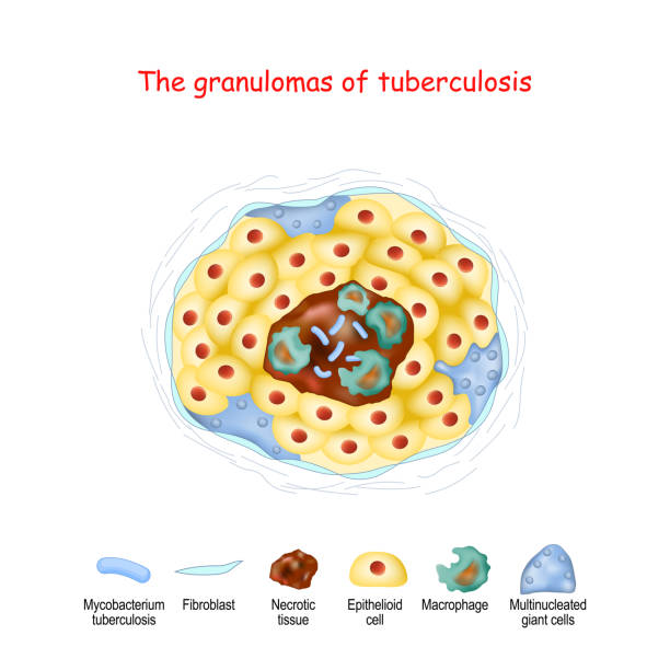The granulomas of tuberculosis. structure of granulomas - Stock Photo