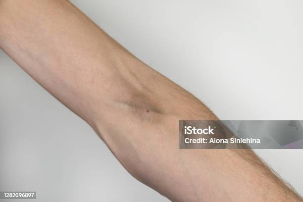 A Male Drug Addict Shows His Hands And Veins Which Show Bruises From The Injections The Concept